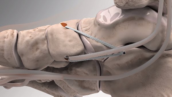 V. James Sammarco, MD | Orthopedic Surgeon Fairfield and Montgomery
