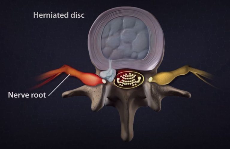 The Difference Between Herniated and Bulging Discs | Beacon Orthopaedics