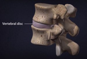 The Difference Between Herniated and Bulging Discs | Beacon Orthopaedics